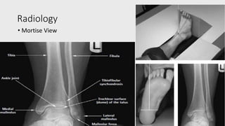 Ankle Fractures.pptx