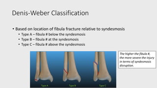 Ankle Fractures.pptx