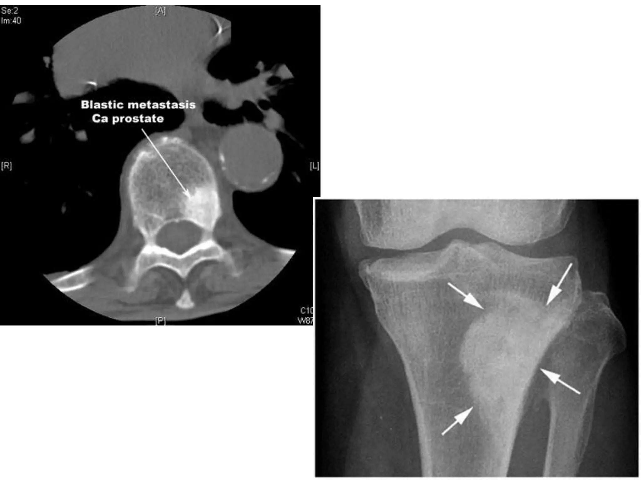 BONE METS & MANAGEMENT. | PPTX