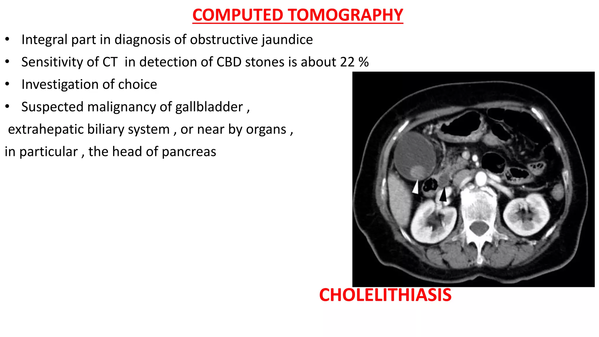 0bstructive jaundice.pptx