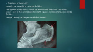 Calcaneal fracture- orthopaedics ,mbbs,ug level | PPTX