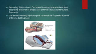 Calcaneal fracture- orthopaedics ,mbbs,ug level | PPTX
