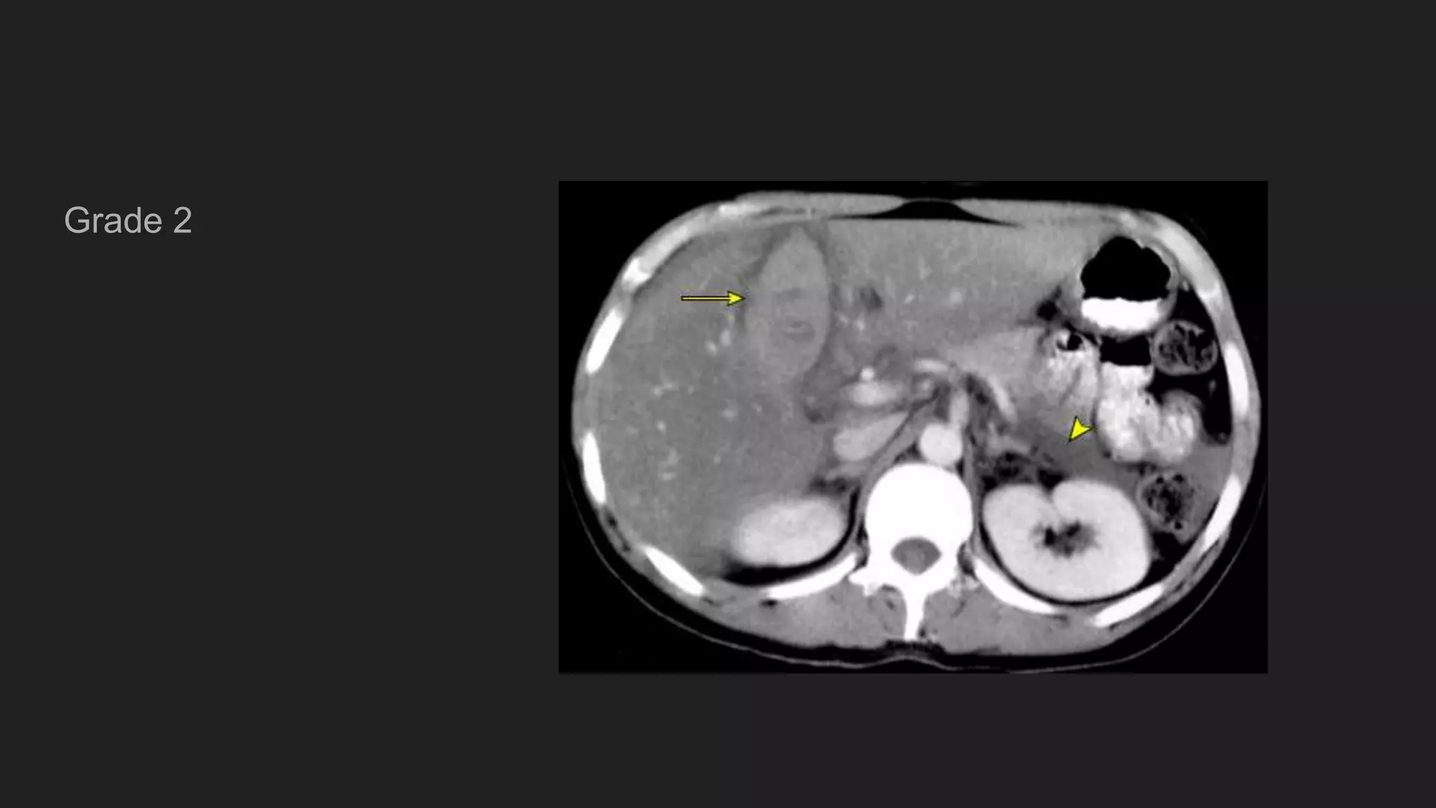 Liver trauma | PPTX | First Aid | Injuries