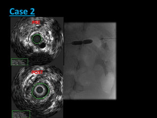 Peds Renal Artery Stenosis - HAWKINS | PPTX