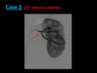 Peds Renal Artery Stenosis - HAWKINS | PPTX