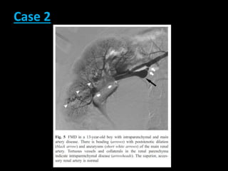 Peds Renal Artery Stenosis - HAWKINS | PPTX