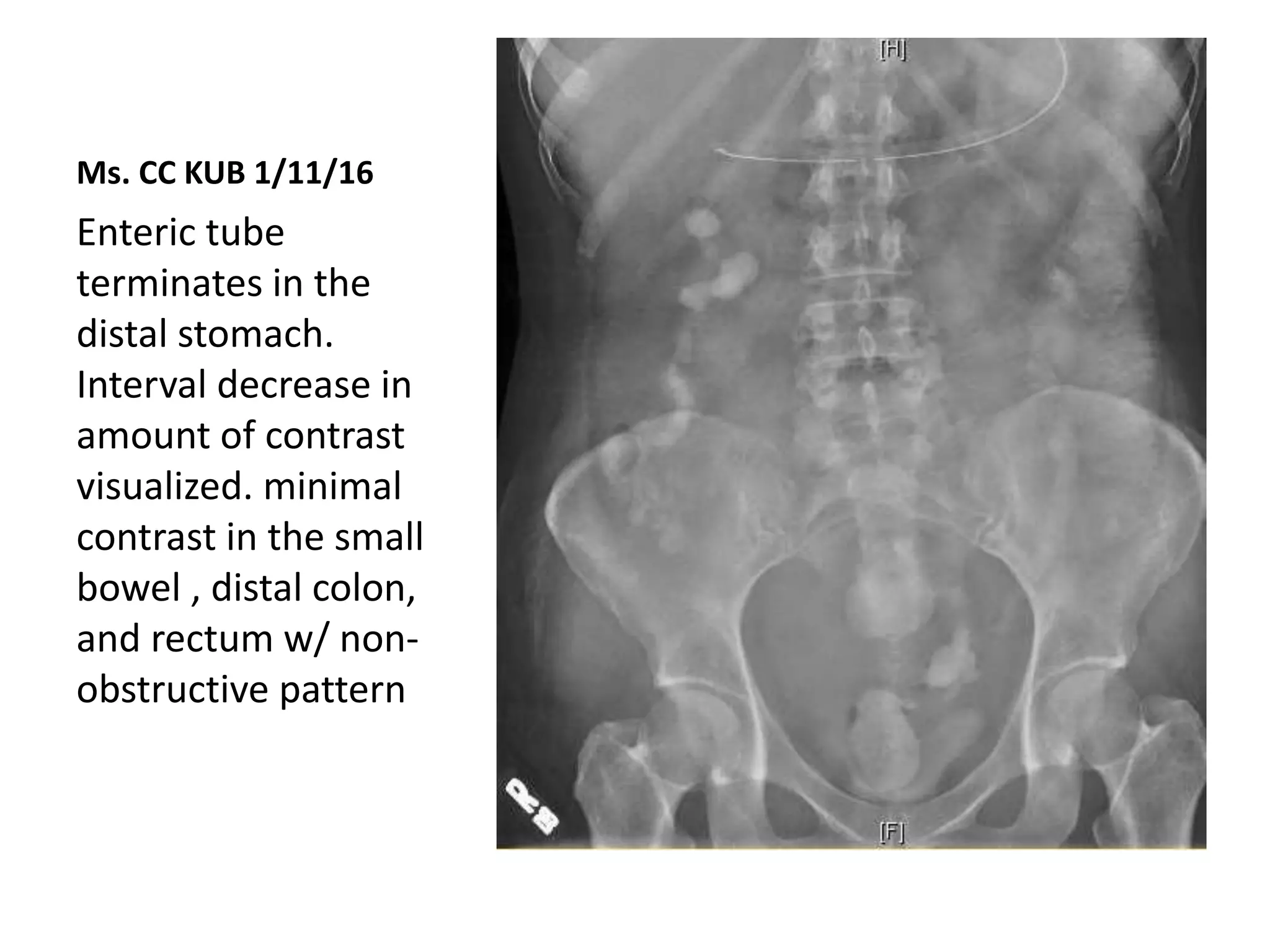 Total abdominal Hysterectomy | PPTX