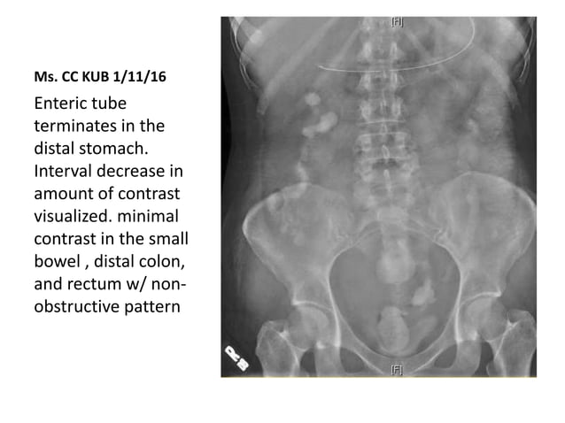 Total abdominal Hysterectomy | PPTX