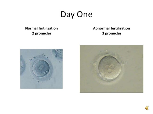 The IVF Journey