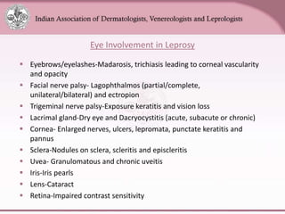 LEPROSY.ppt