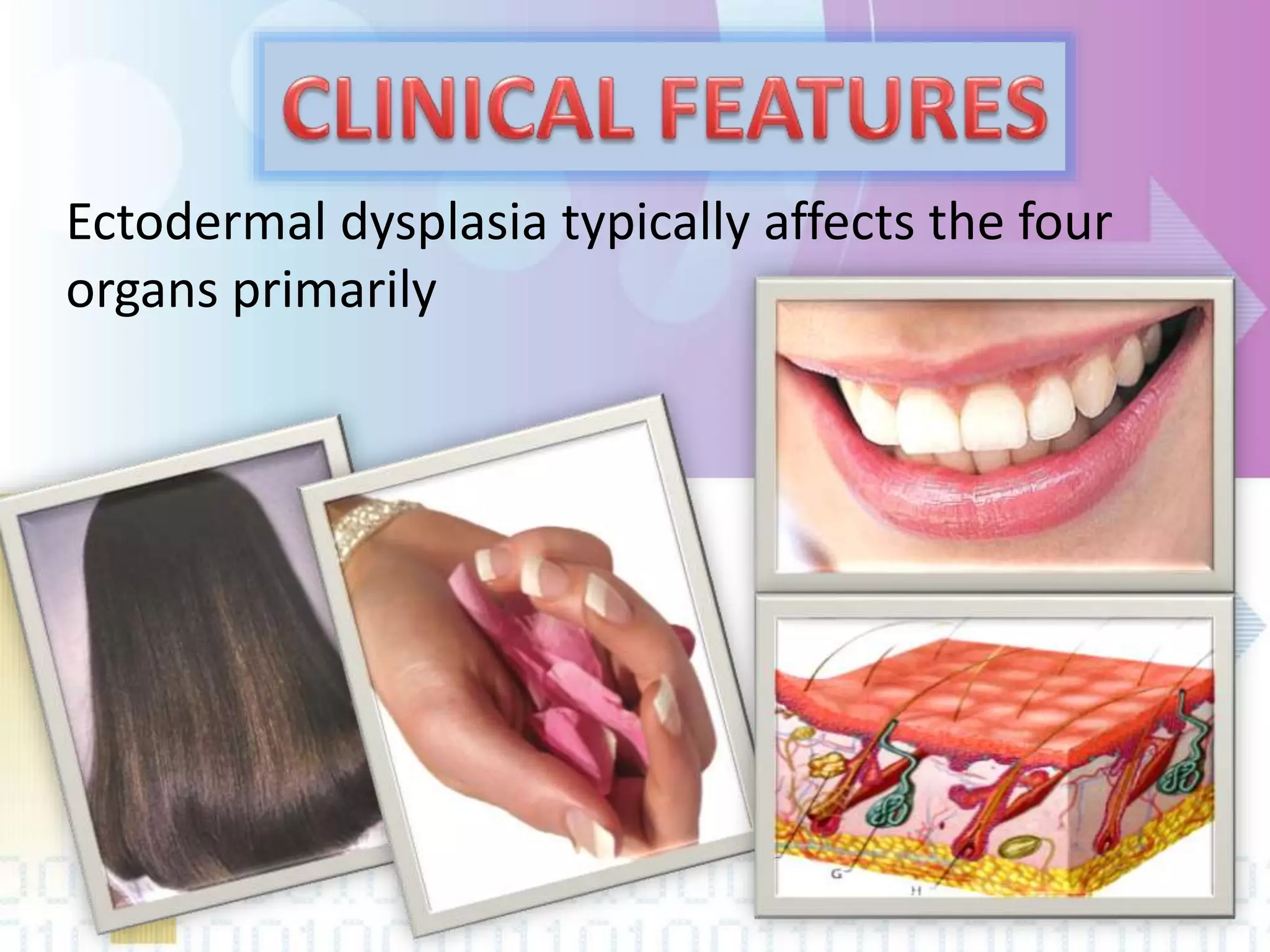 Ectodermal dysplasia | PPTX