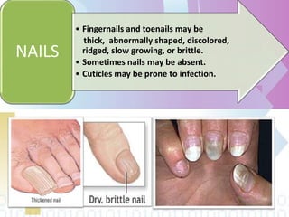 Ectodermal dysplasia | PPTX