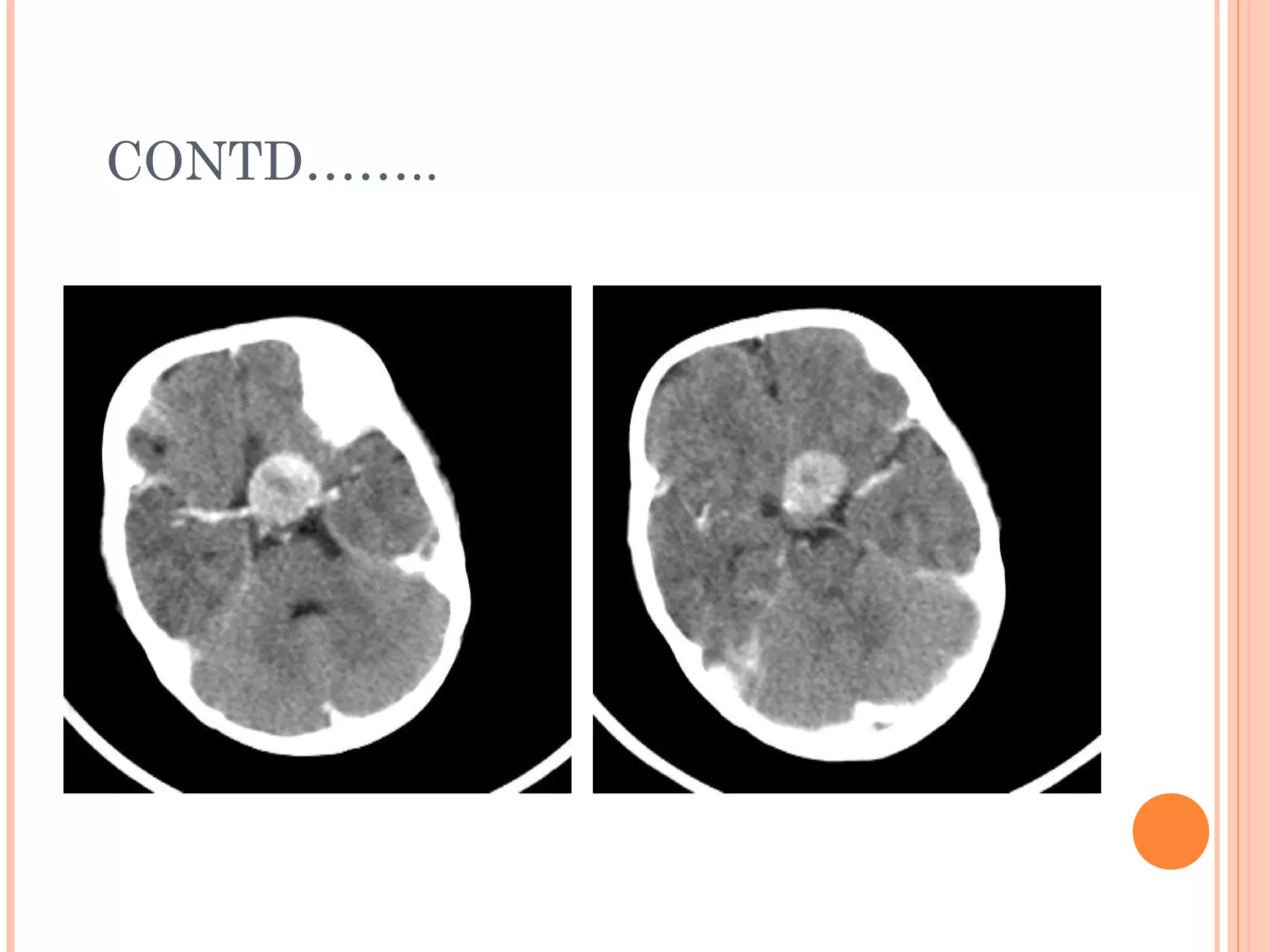Suprasellar mass ct scan of a child | PPT