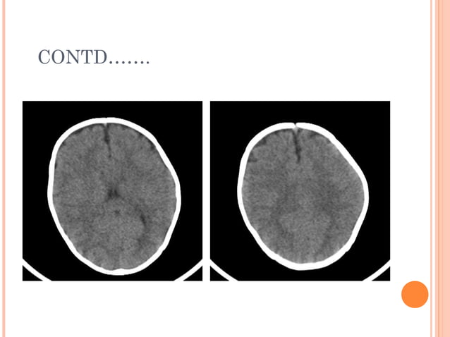 Suprasellar mass ct scan of a child | PPT