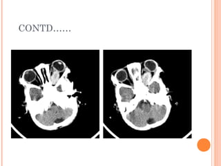 Suprasellar mass ct scan of a child | PPT
