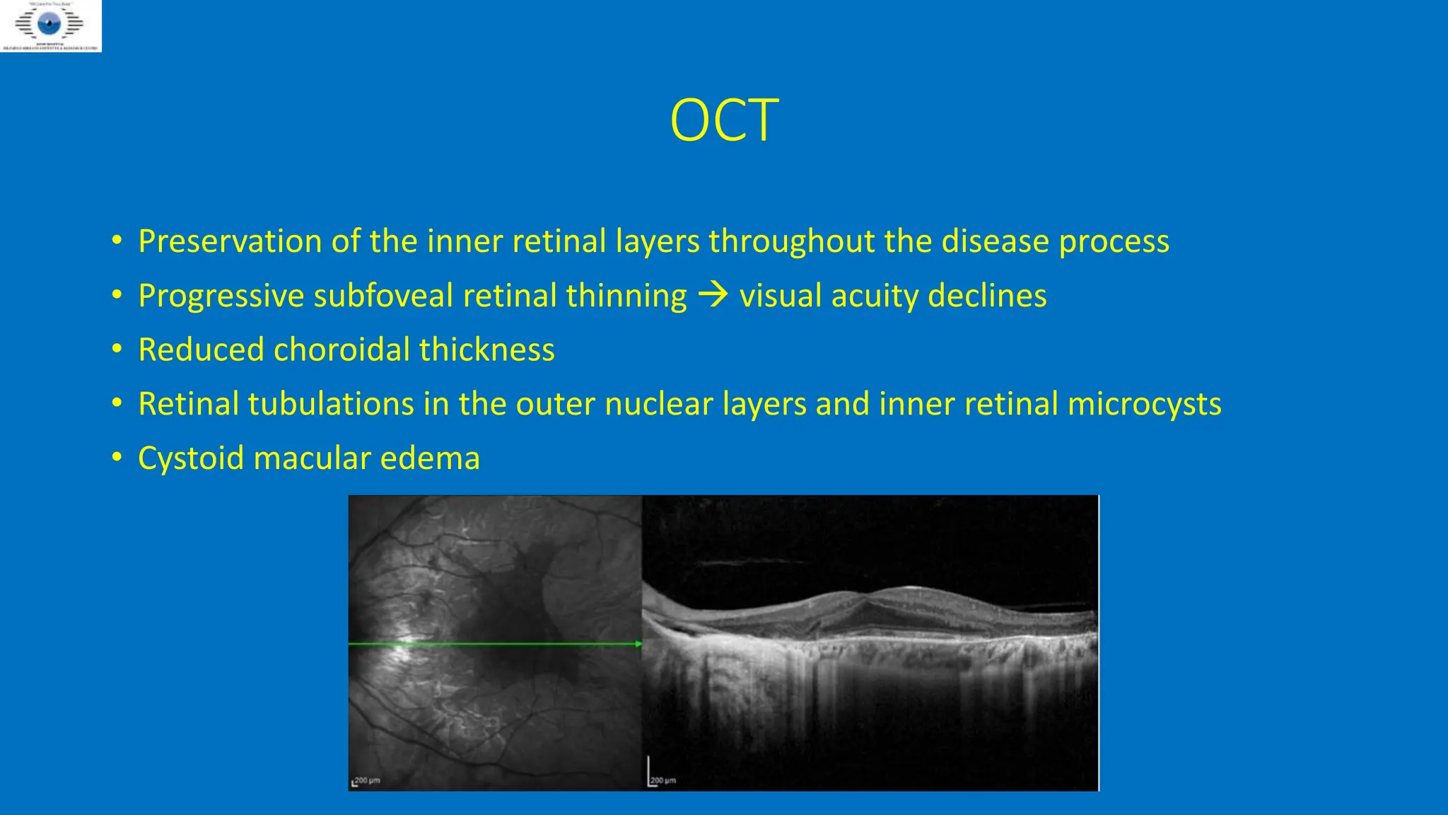 CHOROIDEREMIA presentation dhir hospital bhiwani.pptx