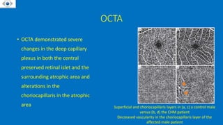 CHOROIDEREMIA presentation dhir hospital bhiwani.pptx