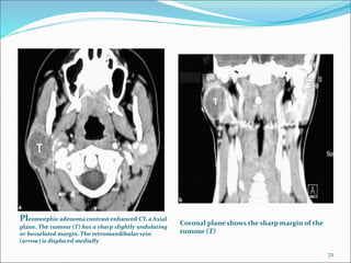 Management Of Benign Salivary Gland Tumors - Okoye | PPTX