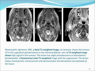 Management Of Benign Salivary Gland Tumors - Okoye | PPTX