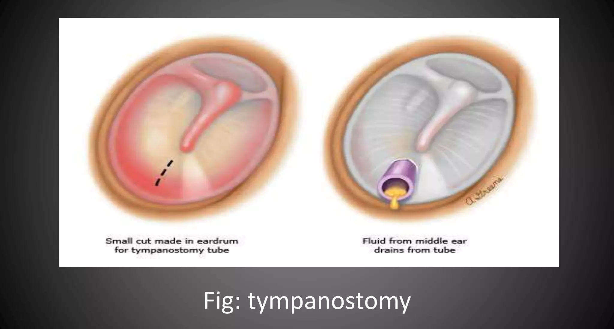 Mastoiditis - inflammation of mastoid bone | PPTX
