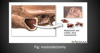 Mastoiditis - inflammation of mastoid bone | PPTX