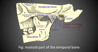 Mastoiditis - inflammation of mastoid bone | PPTX