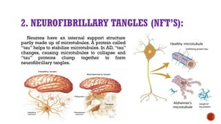 Pathophysiology and management of alzheimer's disease | PDF