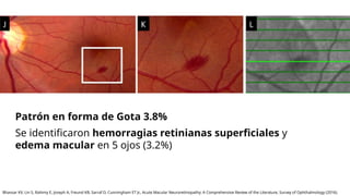 Neurorretinopatia Macular Media y Maculopatia Media Aguda | PPTX