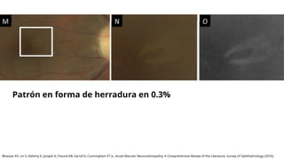 Neurorretinopatia Macular Media y Maculopatia Media Aguda | PPTX