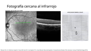Neurorretinopatia Macular Media y Maculopatia Media Aguda | PPTX