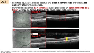 Neurorretinopatia Macular Media y Maculopatia Media Aguda | PPTX