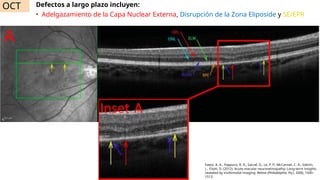 Neurorretinopatia Macular Media y Maculopatia Media Aguda | PPTX