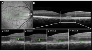 Neurorretinopatia Macular Media y Maculopatia Media Aguda | PPTX