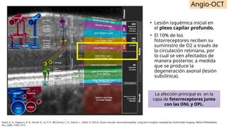 Neurorretinopatia Macular Media y Maculopatia Media Aguda | PPTX