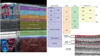 Neurorretinopatia Macular Media y Maculopatia Media Aguda | PPTX