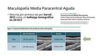 Neurorretinopatia Macular Media y Maculopatia Media Aguda | PPTX
