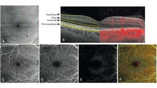Neurorretinopatia Macular Media y Maculopatia Media Aguda | PPTX