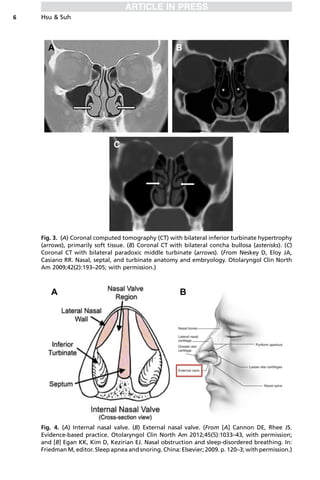 Nasal obstruction.pdf