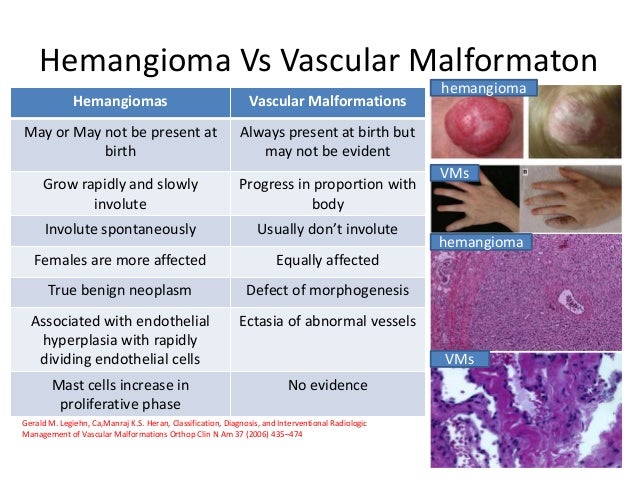 Recent trends in management of vascular malformation