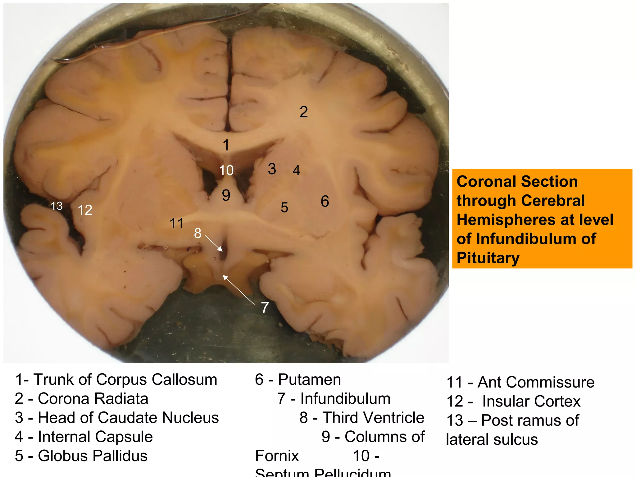 cerebrum sections for revision | PPT
