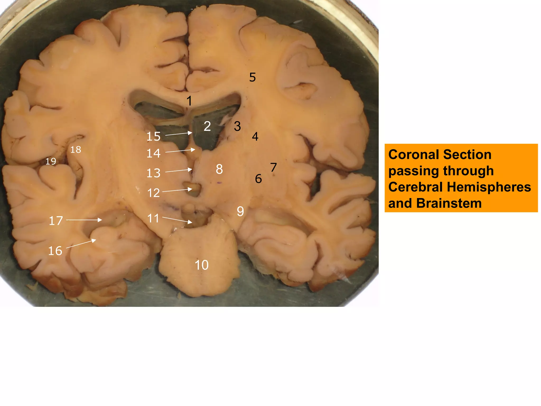 cerebrum sections for revision | PPT