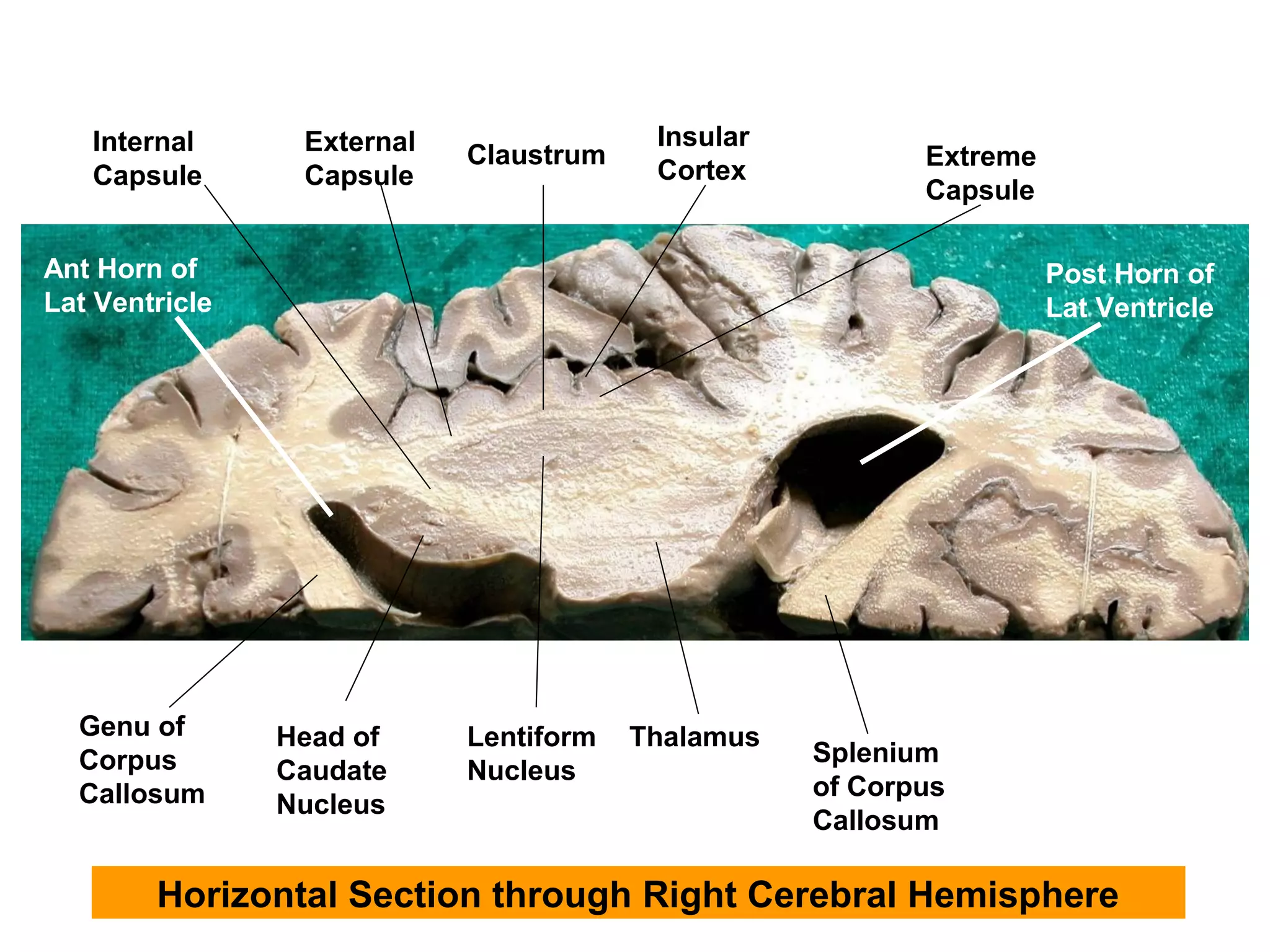 cerebrum sections for revision | PPT