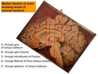 cerebrum sections for revision | PPT