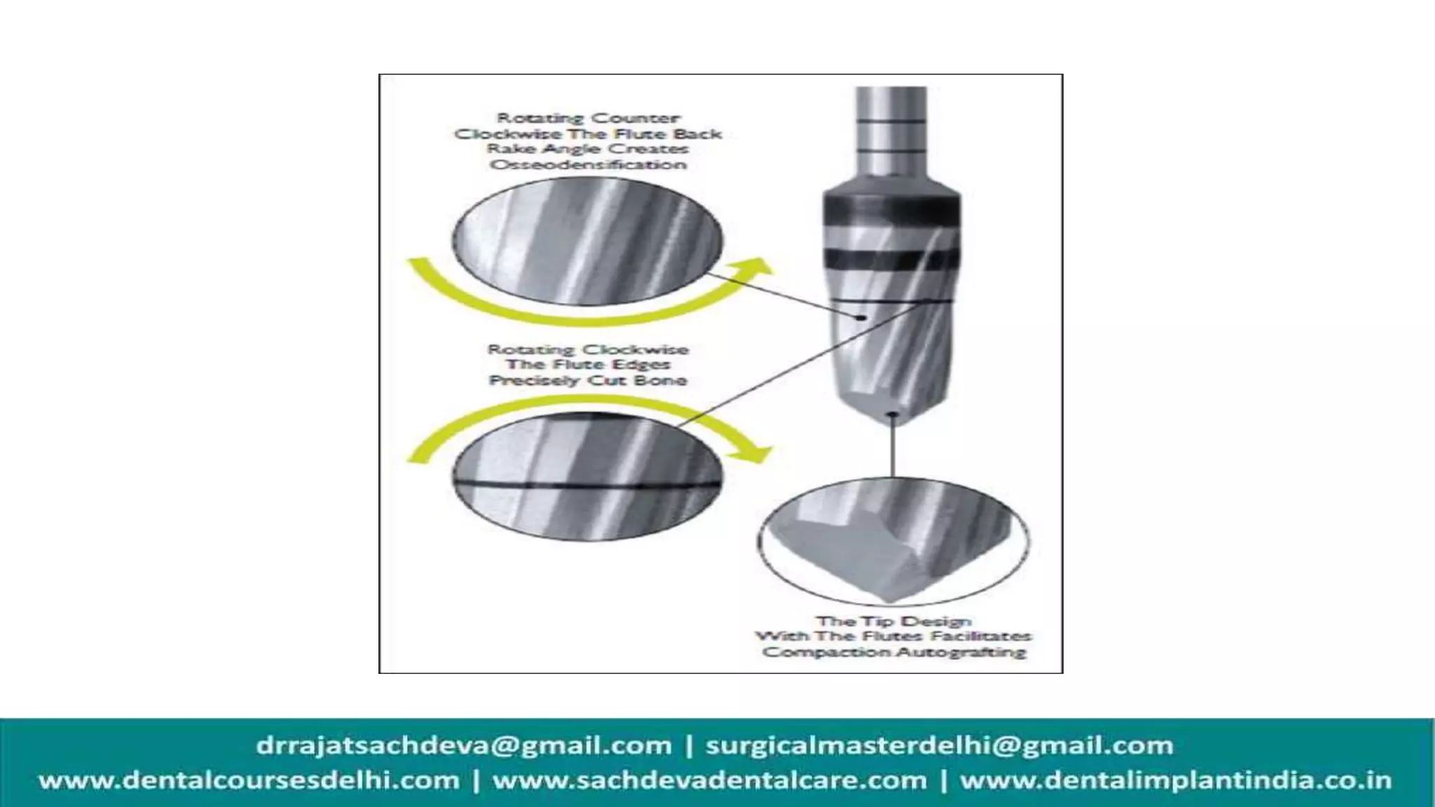 0sseodensification in implants | Densah in implants | Dental Implants ...