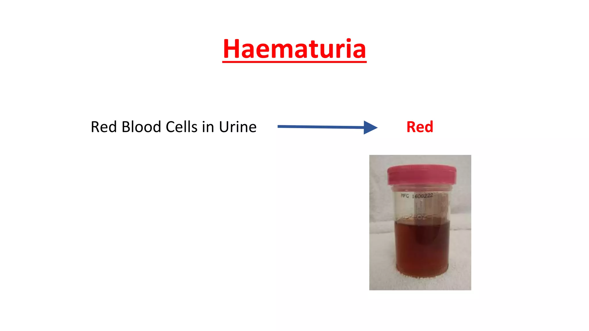 Haematuria | PPTX