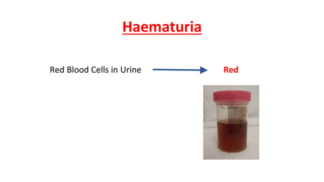 Haematuria | PPTX