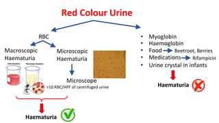 Haematuria | PPTX