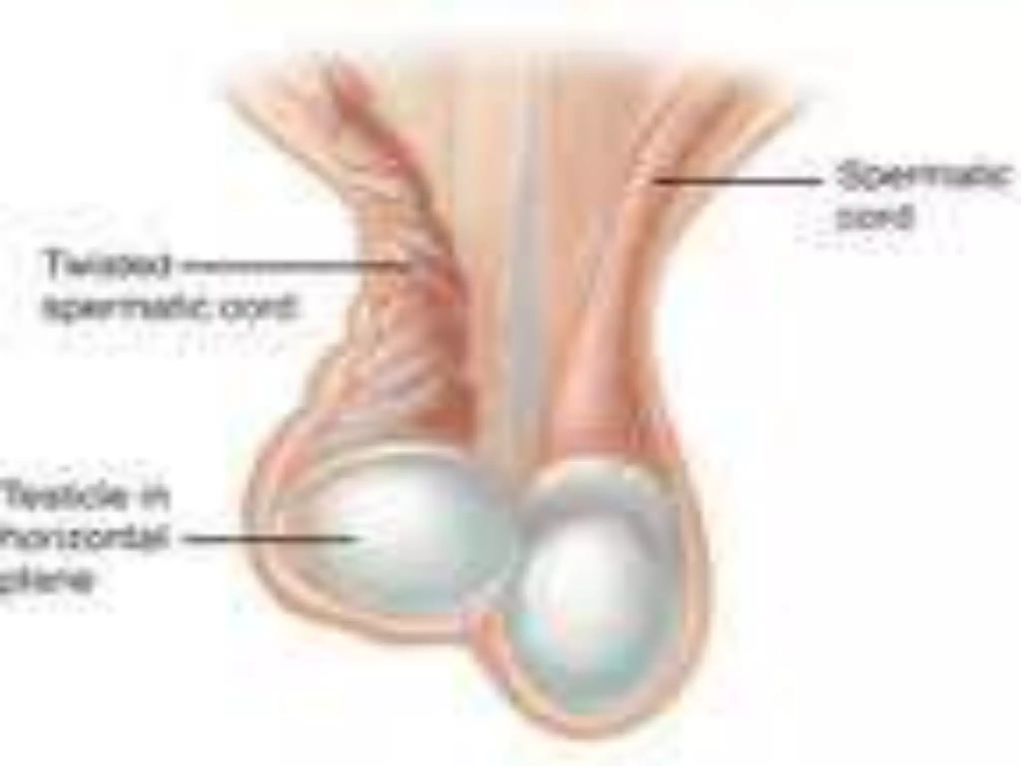 The Acute Scrotum Ppt