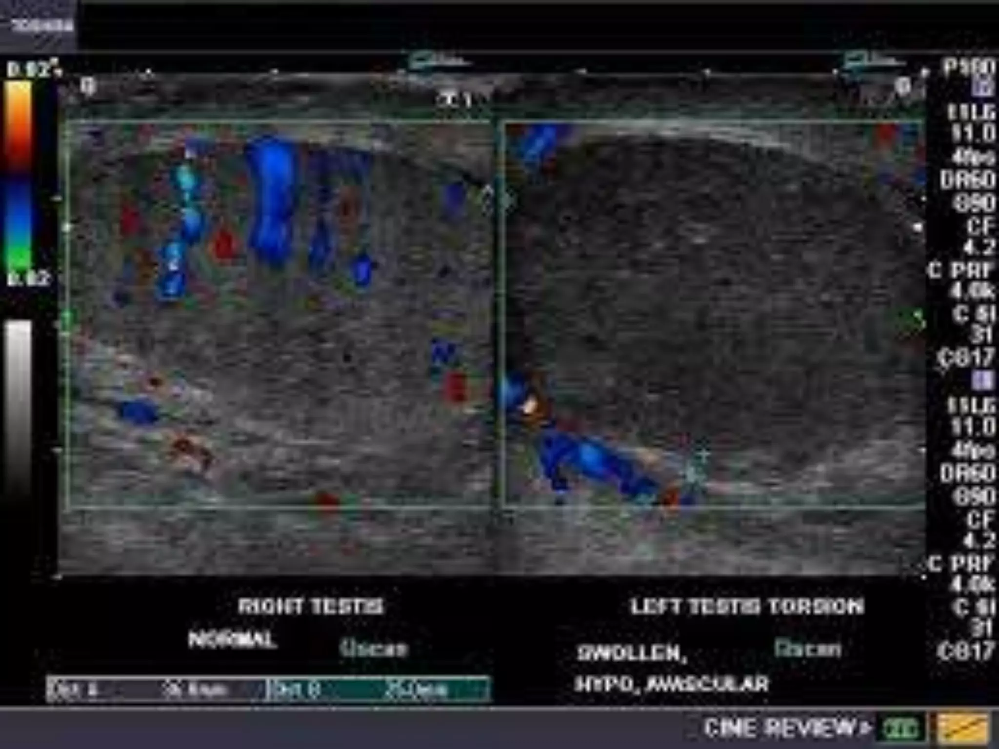 The acute scrotum | PPTX