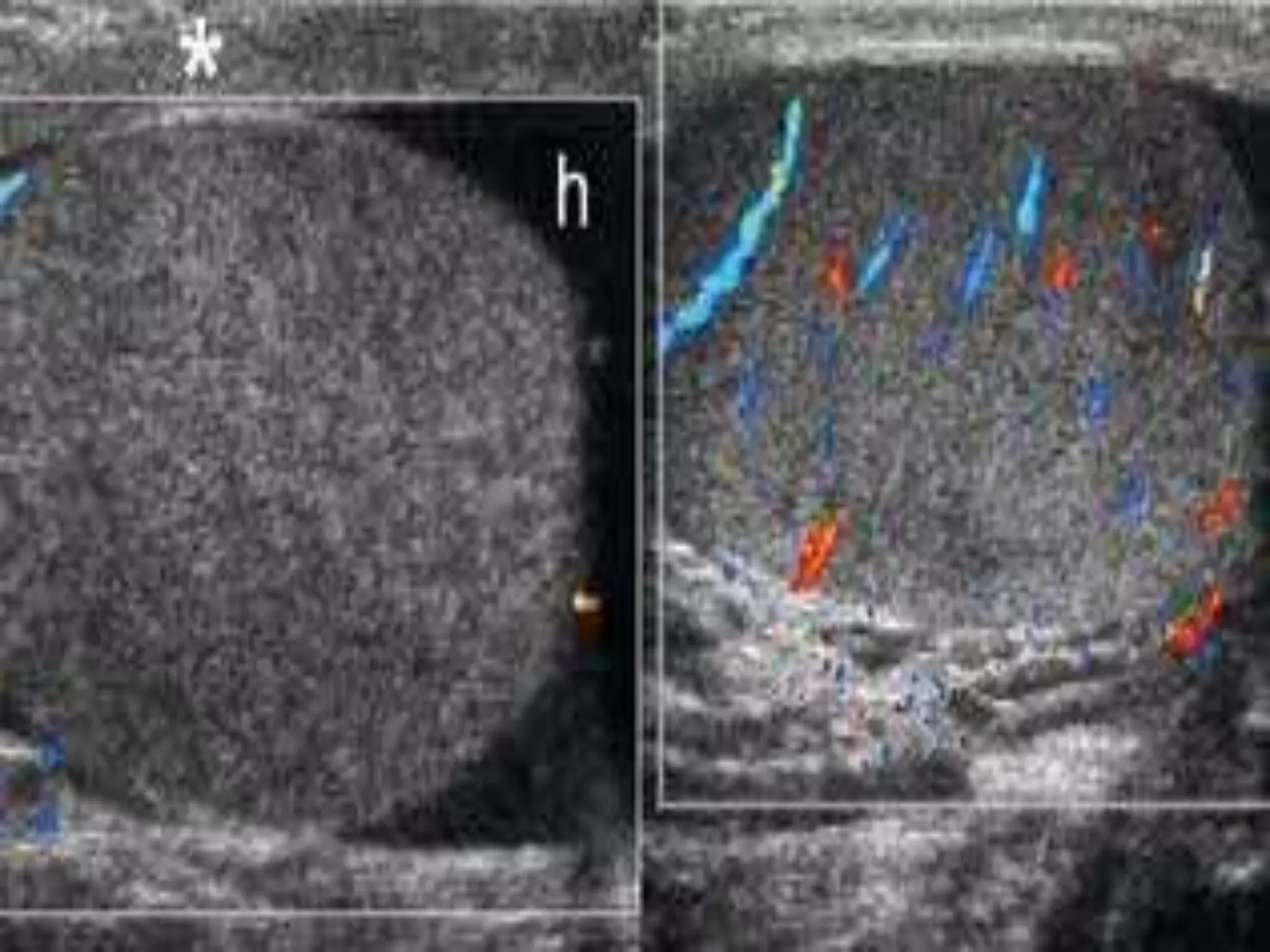 The acute scrotum | PPTX